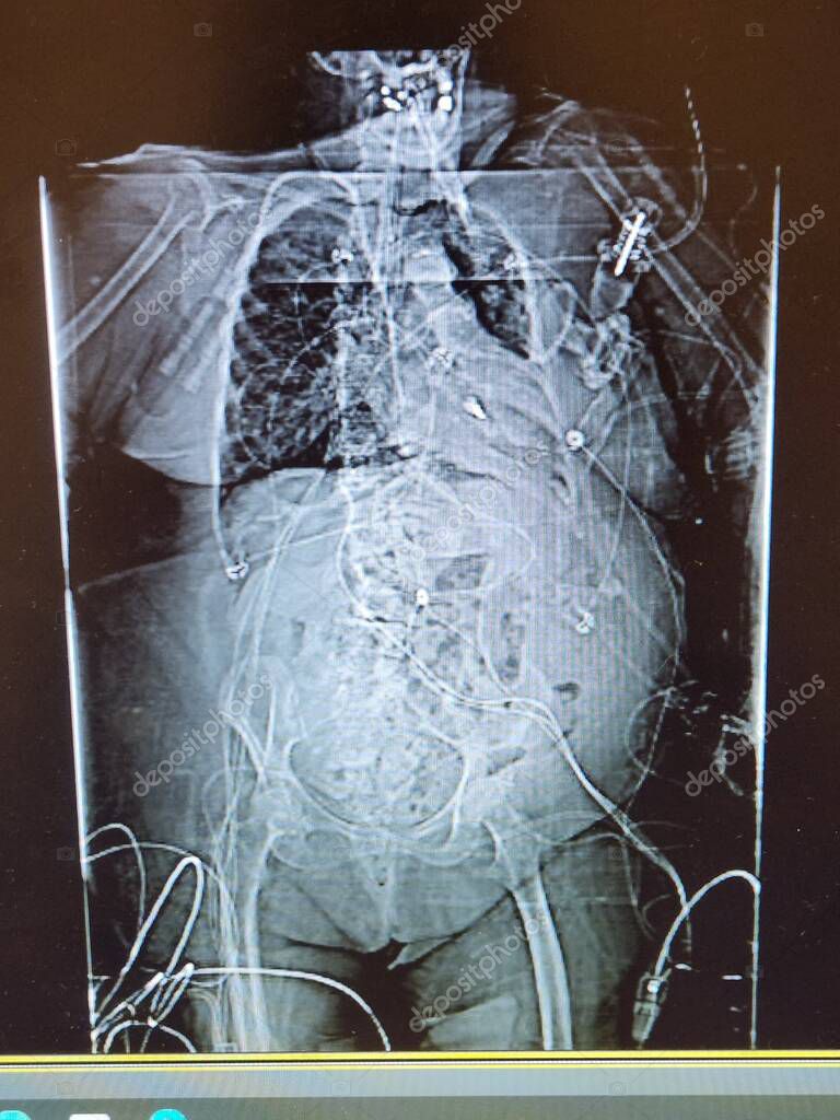 Anasarca severa, ascitis en radiografía de tórax, abdomen 2023