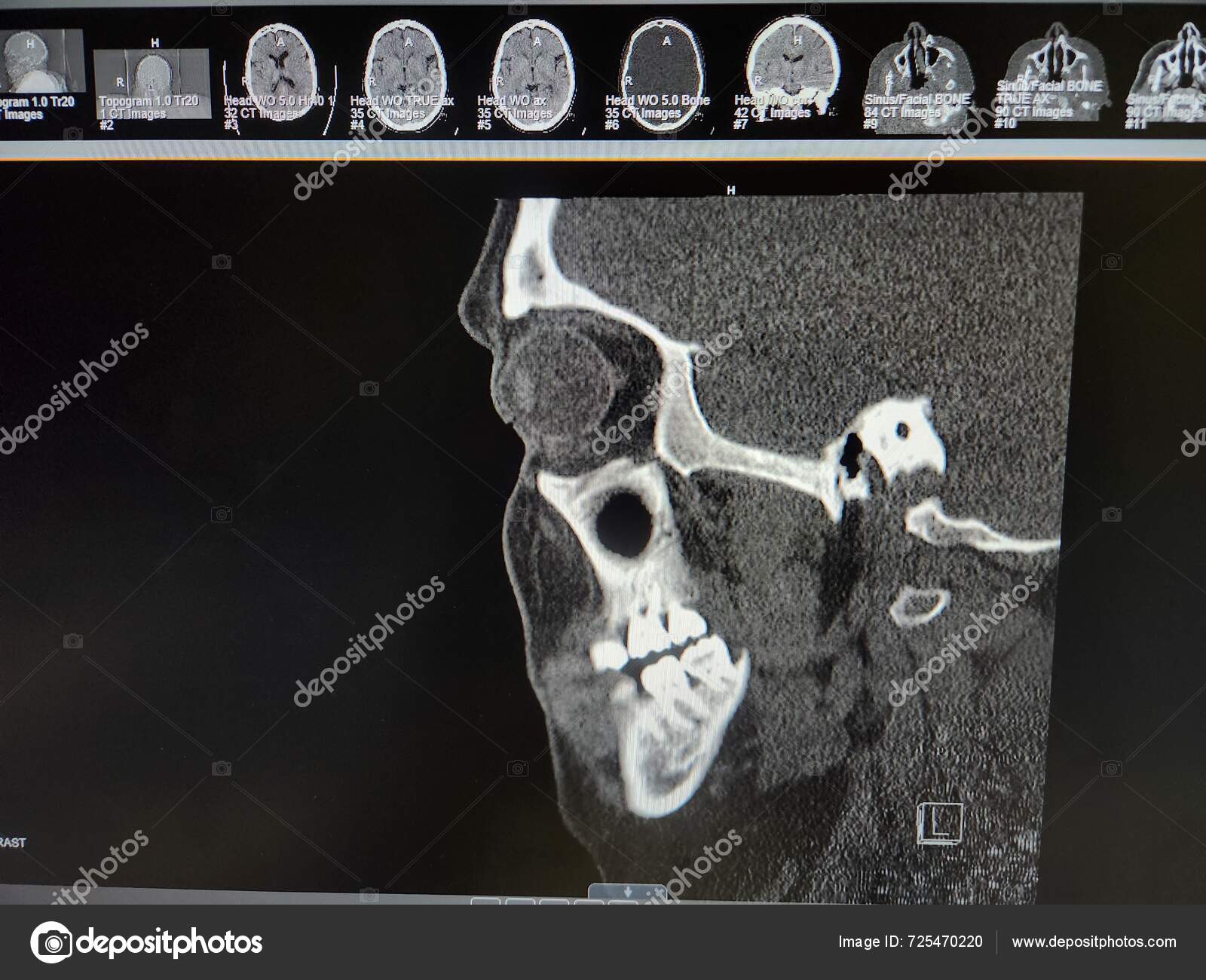 Scan Face Sinuses Bones Soft Tissues — Stock Photo © CreativeEndeavors6 ...