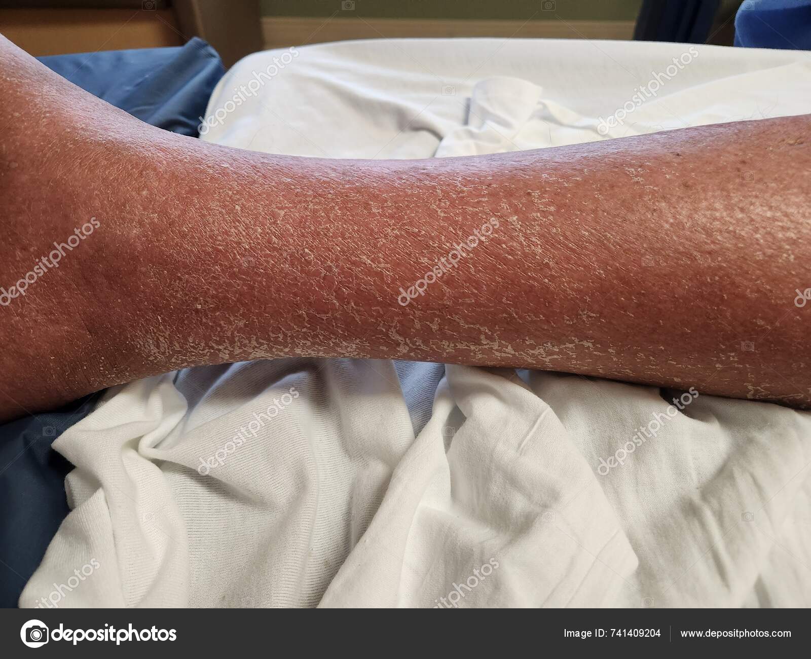 Pembroliimab Rash Edema Desquamation Cancer Patient — Stock Photo ...