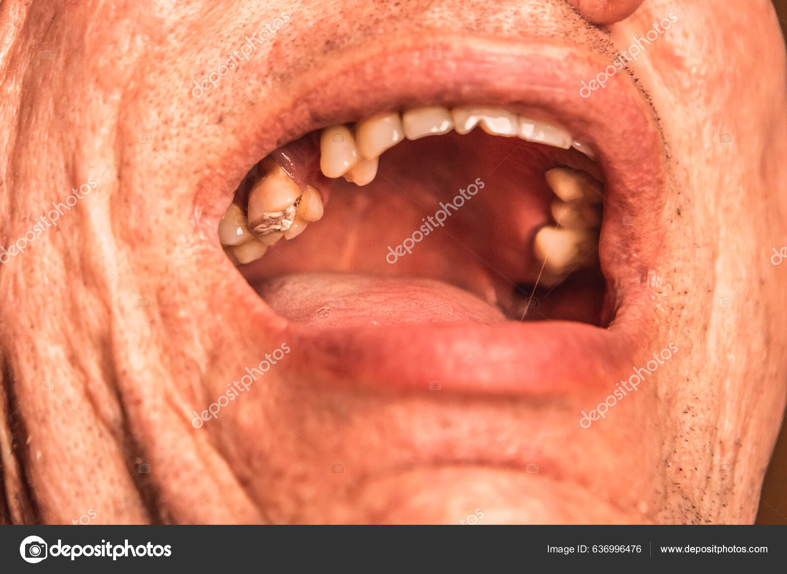 Close Man Open Mouth Jaw Teeth Detailed Sealed Tooth Surgery Stock ...