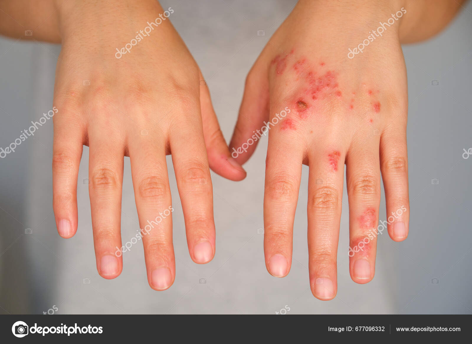 Manos Paciente Con Sin Comparación Eccema Dermatitis Piel Atópica ...