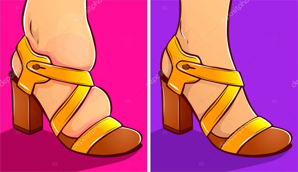 Zapatos incómodos, hinchazón de los pies. Antes, después. Ilustración ...