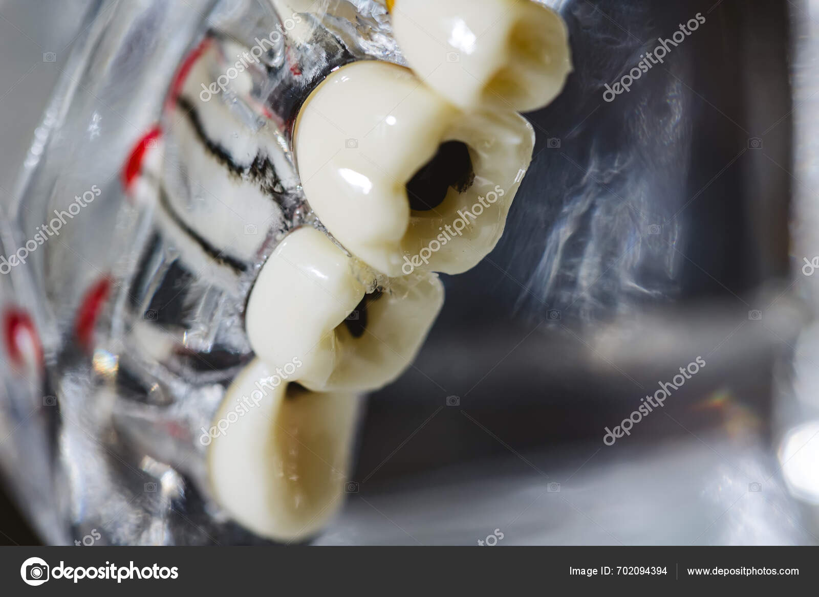 Caries Tooth Model Oral Care Concept Dental Model Present Common ...