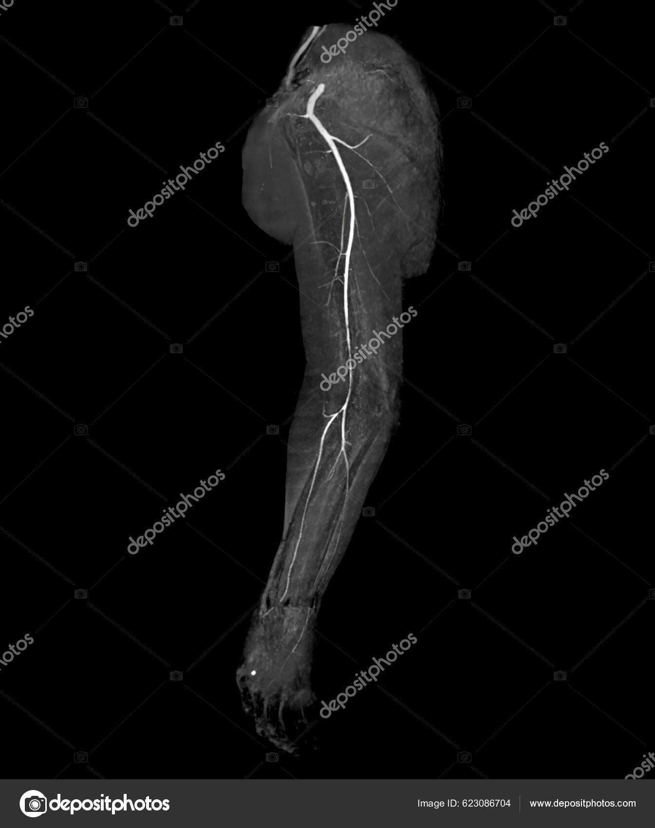 Cta Brachial Artery Scan Upper Extremity Rendering Image — Stock Photo ...
