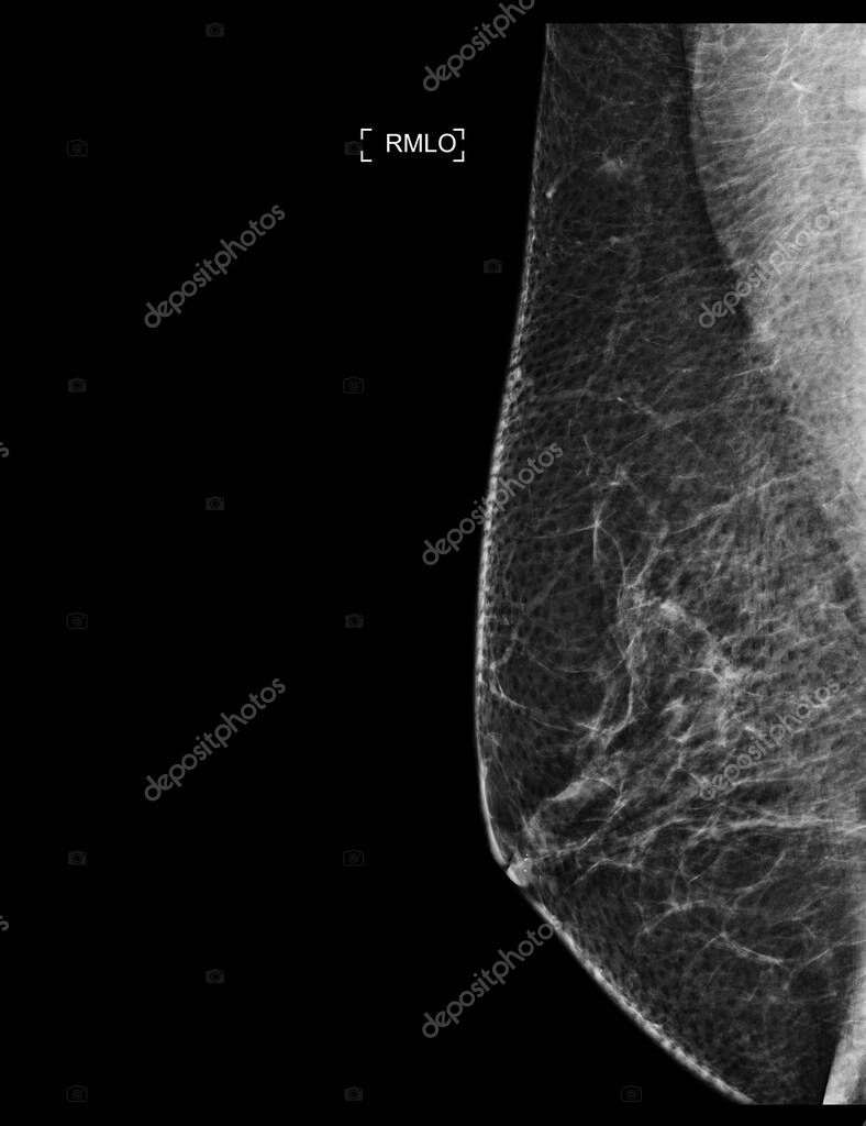 Radiografía La mamografía digital o la mamografía de ambas mamas ...
