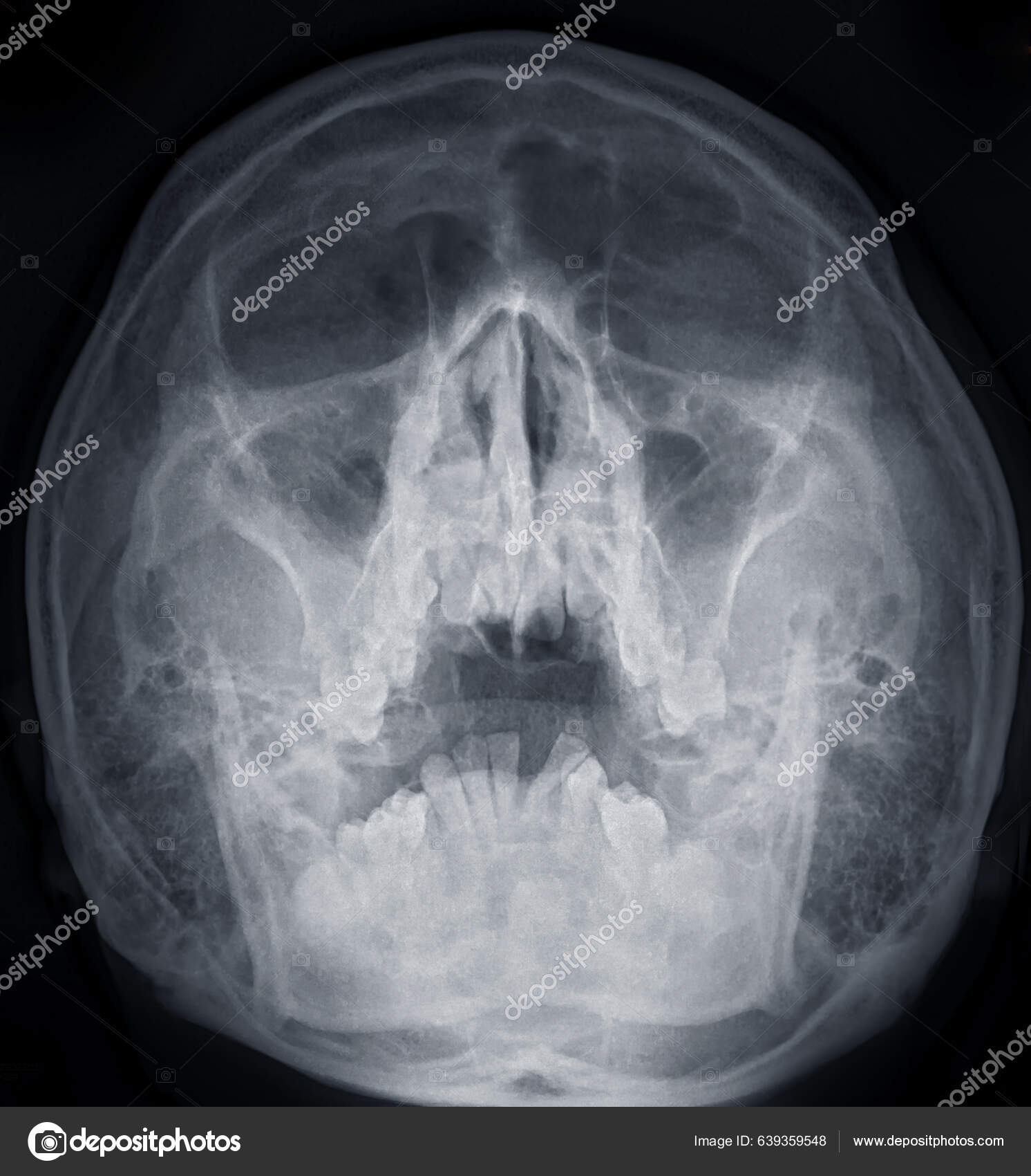 Radiografía De Los Senos Paranasales