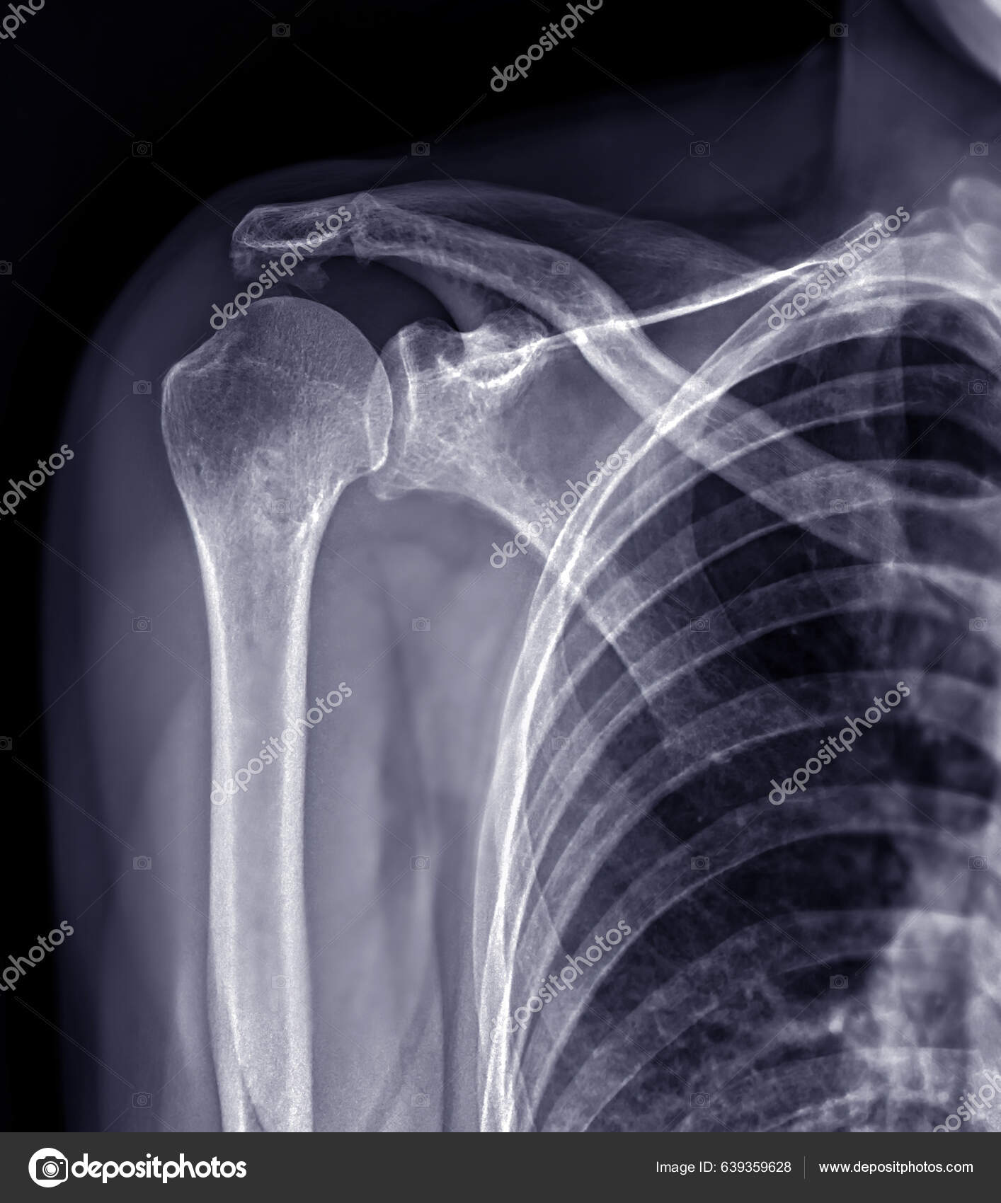 Rentgen Přední Pohled Ramenního Kloubu Pro Diagnózu Zlomeniny Ramenního ...