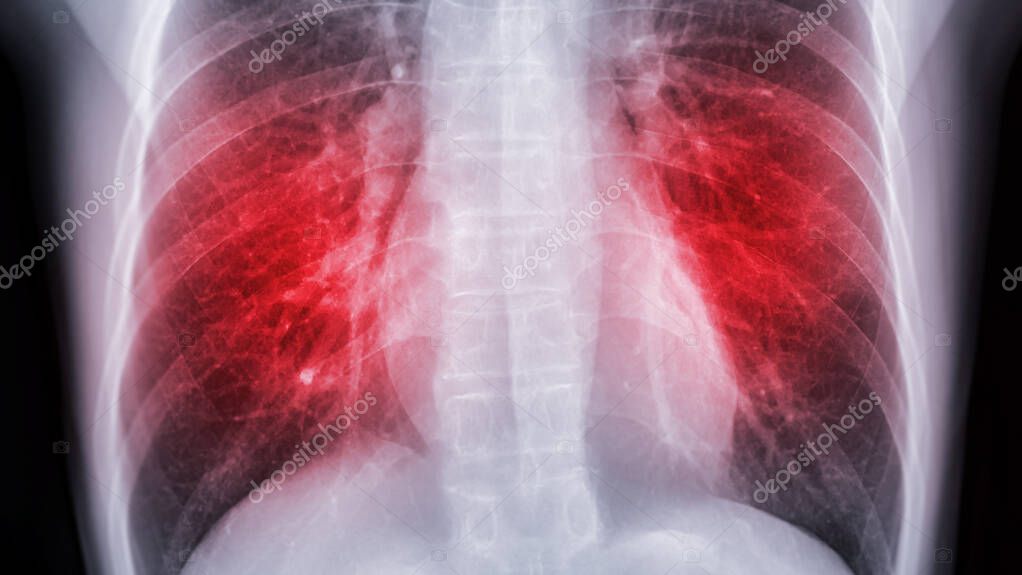 Imagen de radiografía de tórax para diagnóstico de detección TB ...