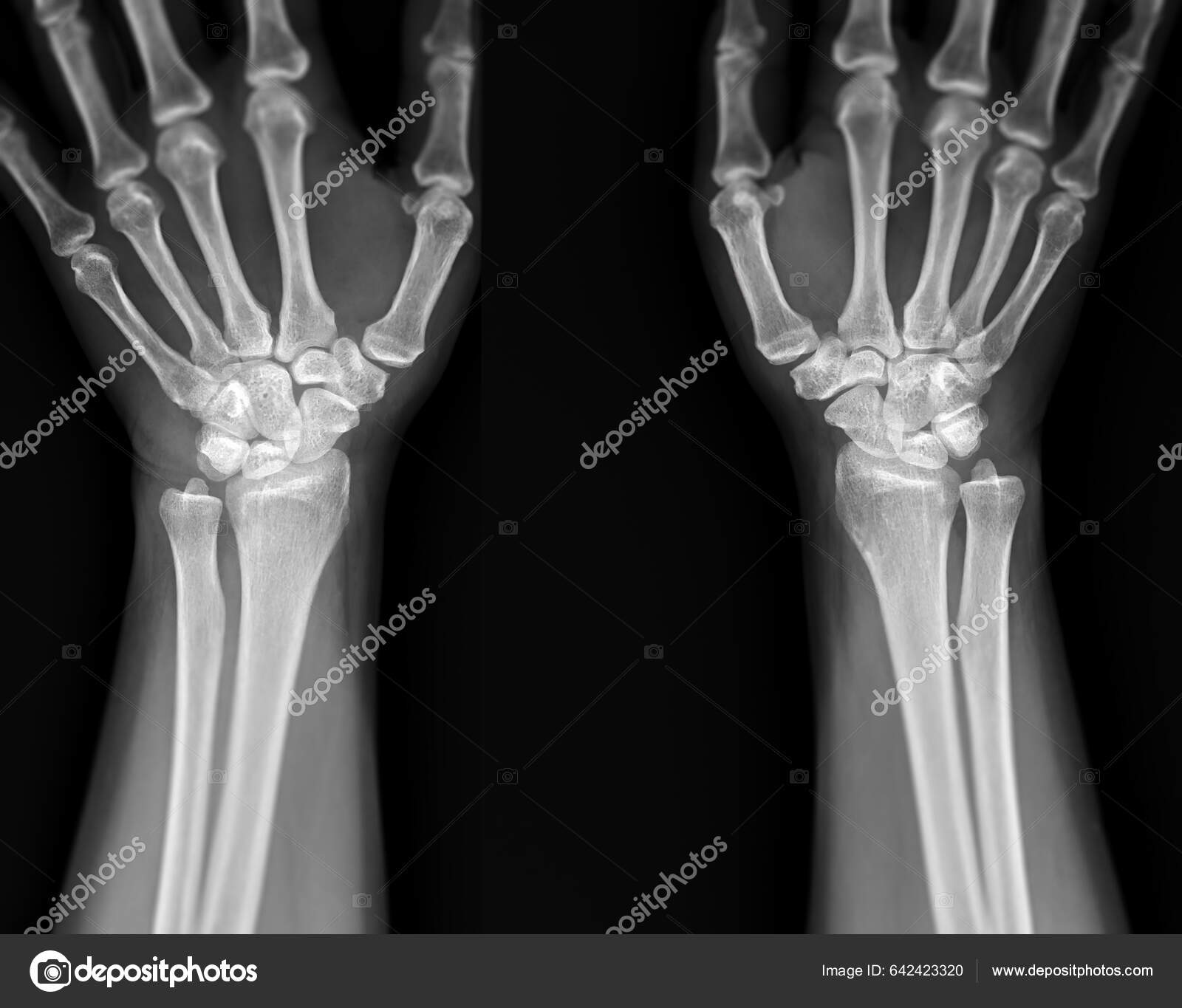 Wrist Joint X Ray