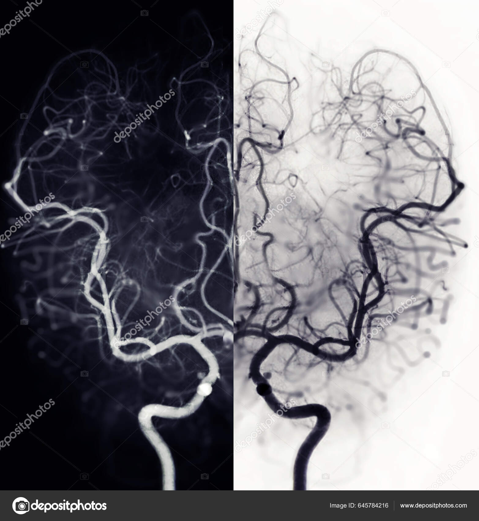 Cerebral Angiography Image Fluoroscopy Intervention Radiology Showing ...