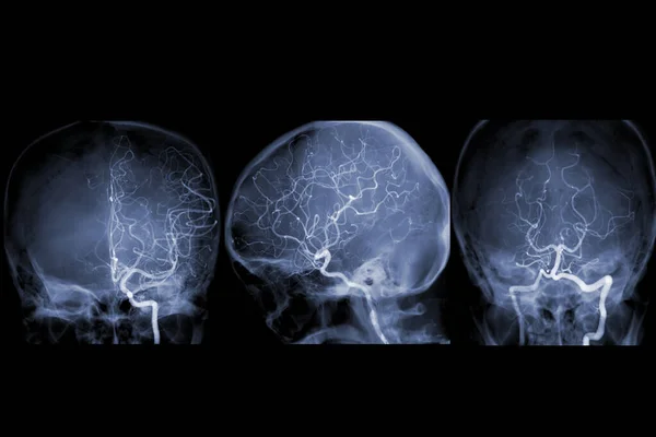 Cerebral vascular angiography Stock Photos, Royalty Free Cerebral ...