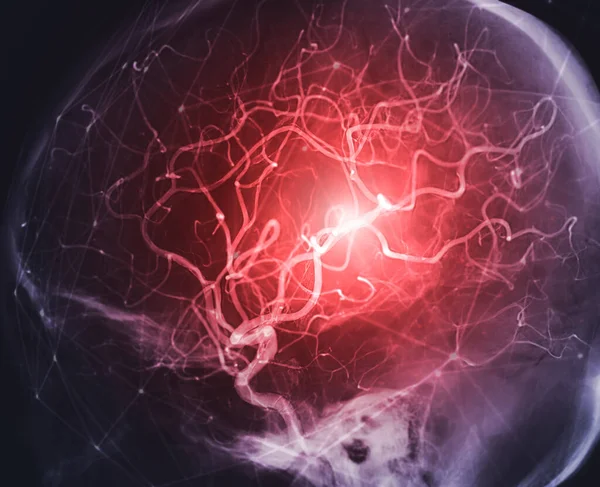 Cerebral vascular angiography Stock Photos, Royalty Free Cerebral ...