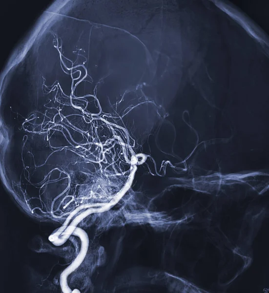 Cerebral vascular angiography Stock Photos, Royalty Free Cerebral ...