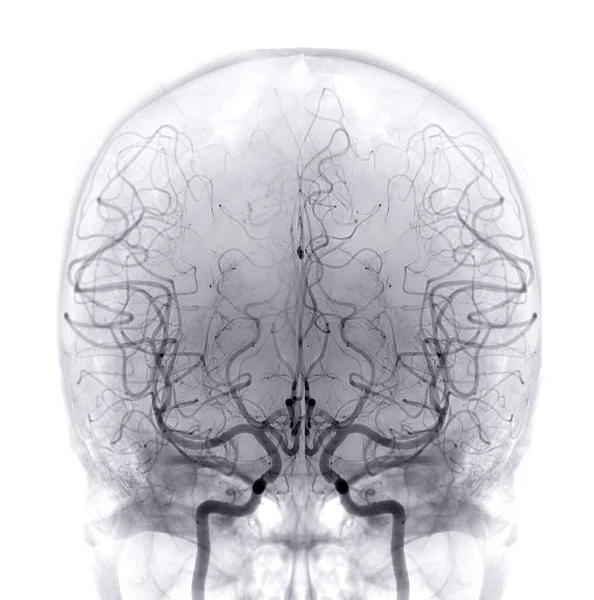Cerebral vascular angiography Stock Photos, Royalty Free Cerebral ...