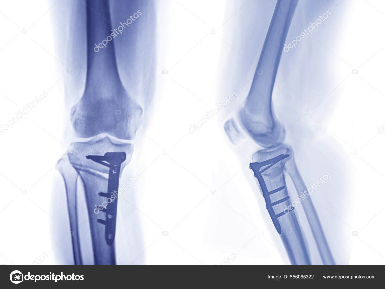 Ray Image Right Knee Lateral View Showing Total Knee Arthroplasty Stock ...
