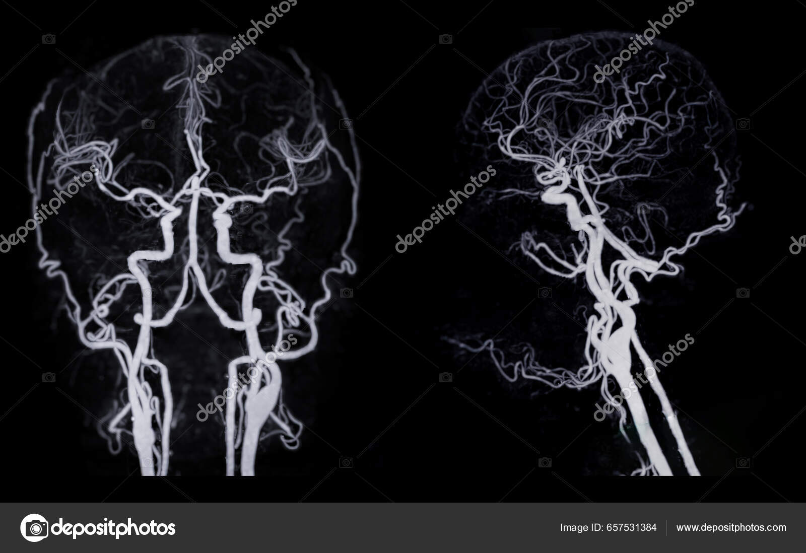 Angiography Brain Cta Brain Showing Cerebral Artery — Stock Photo ...