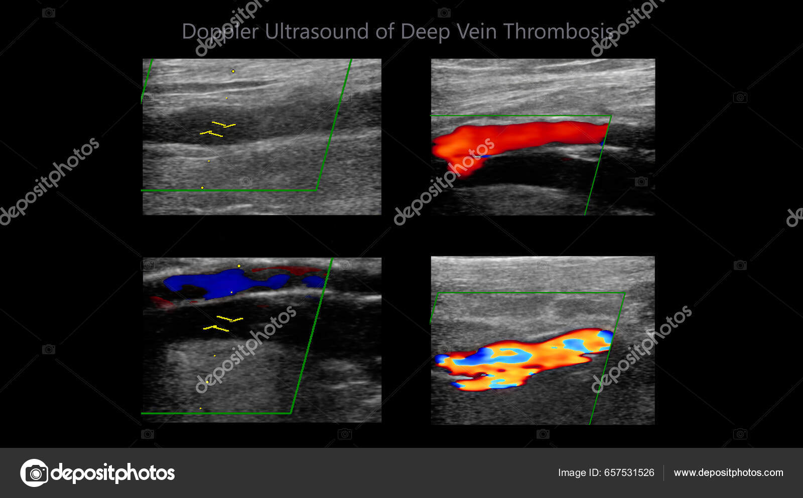 Determinación Por Ultrasonido Doppler Color Pacientes Con Trombosis ...