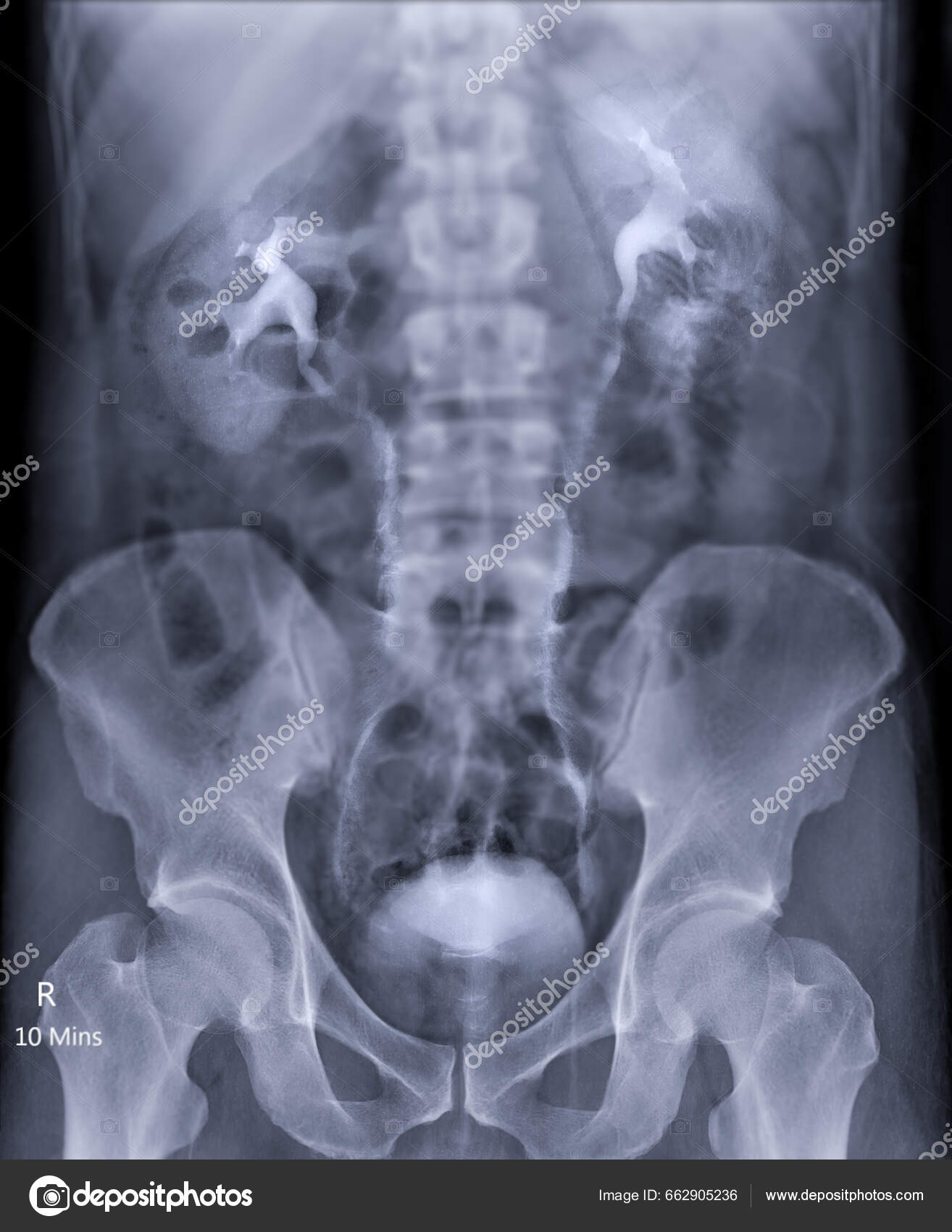 Intravenous Pyelogram Ray Exam Urinary Tract Injection Contrast Media ...