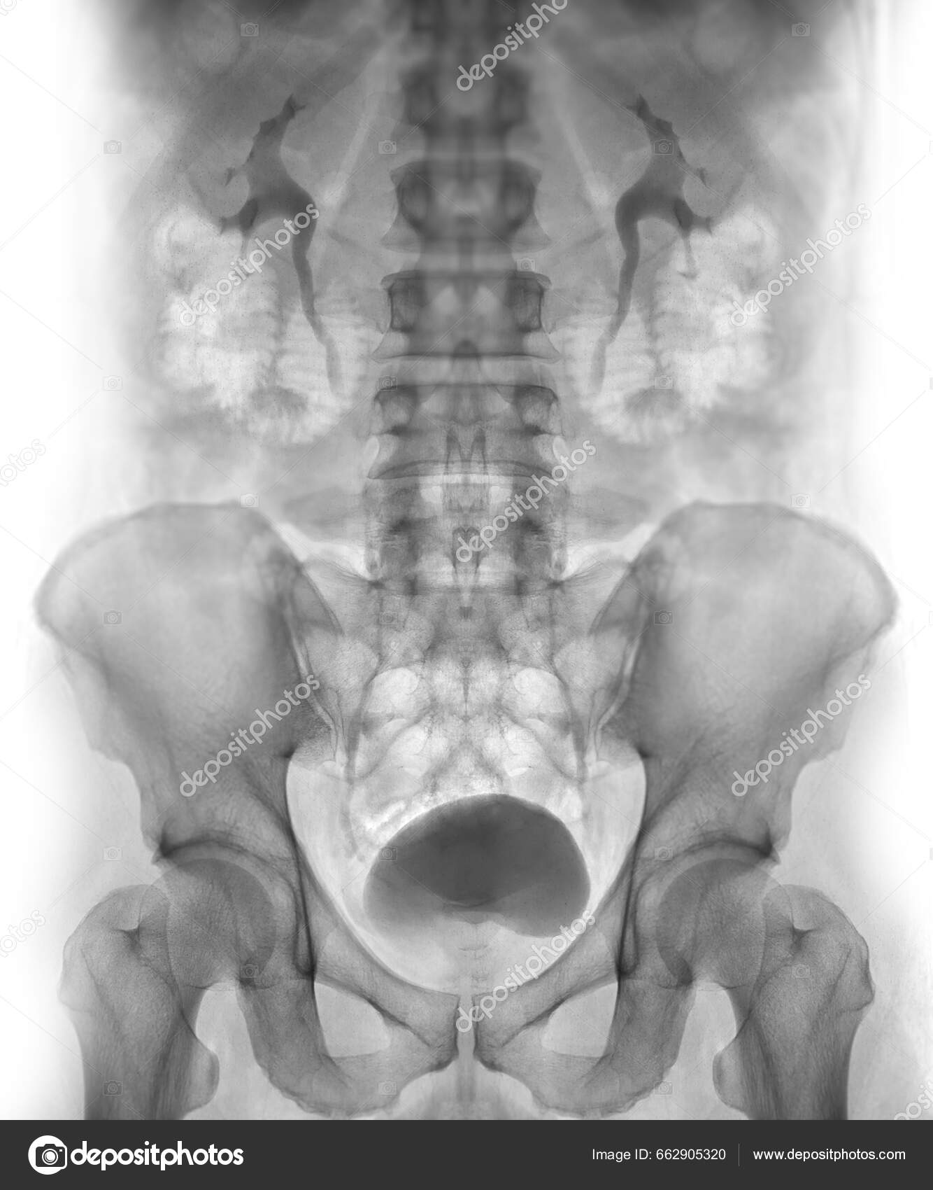 Intravenous Pyelogram Ray Exam Urinary Tract Injection Contrast Media ...