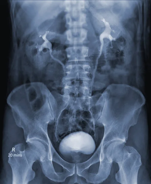 Intravenous Pyelogram Ray Exam Urinary Tract Injection Contrast Media ...