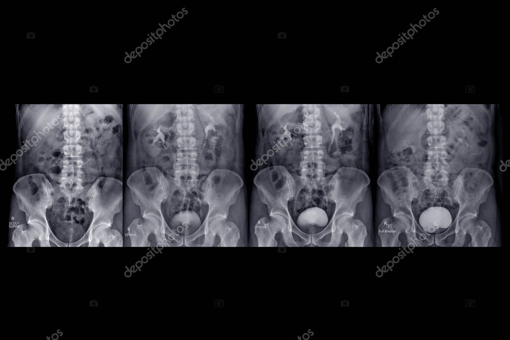 El pielograma intravenoso o I.V.P es un examen de rayos X del tracto ...