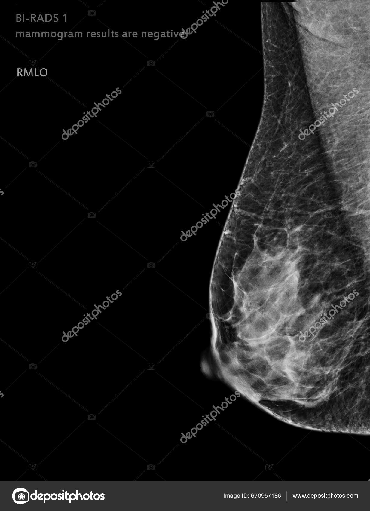 Breast Cancer Digital Mammogram