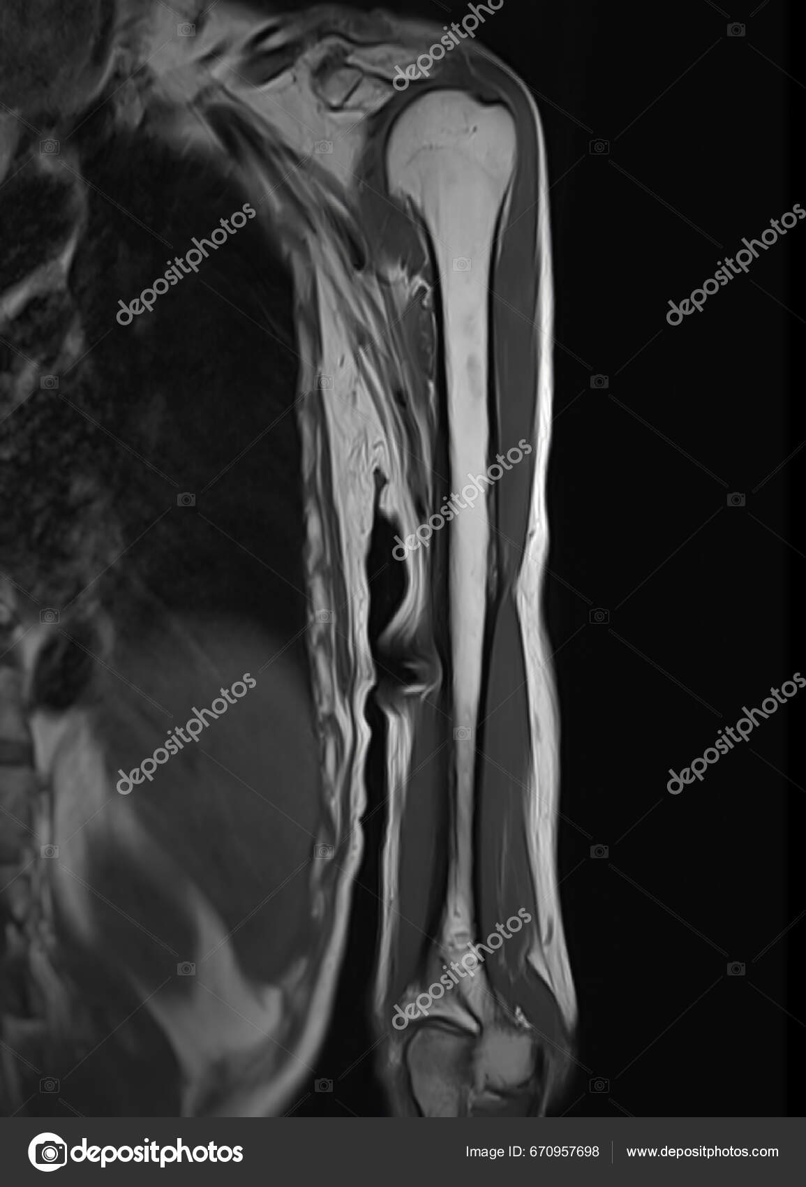 Mri Tulang Humerus Kiri Untuk Diagnosis Tumor Tulang — Foto Stok ...