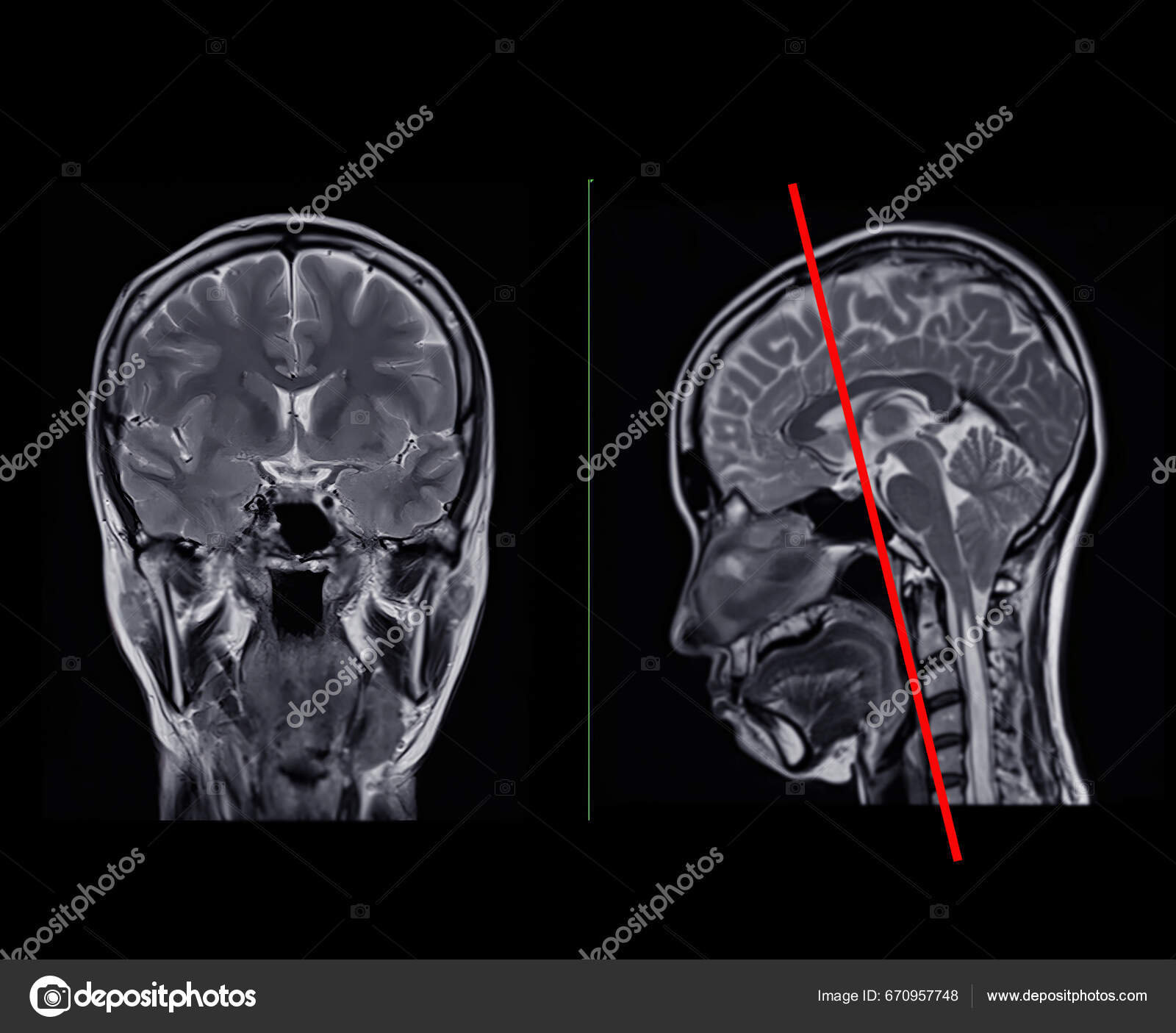 Sagittal Brain Mri