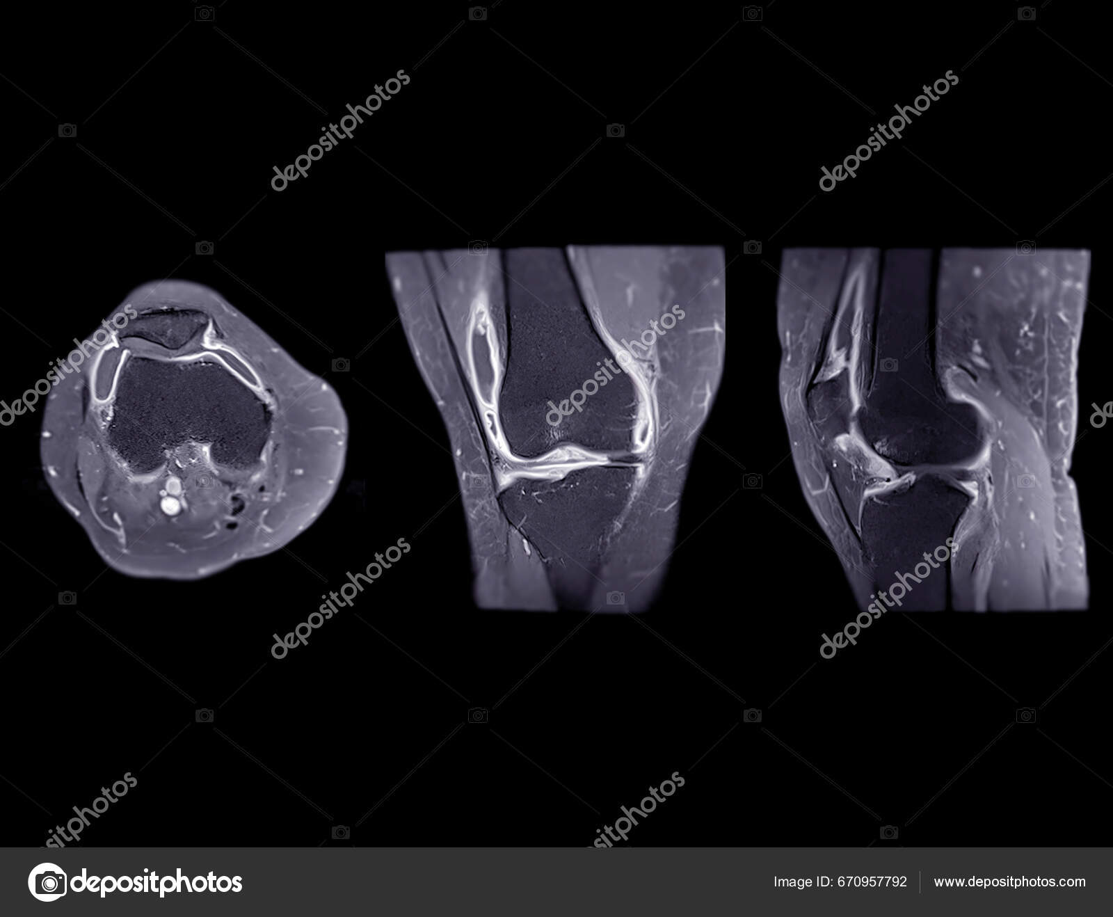 Mri Knee Axial Mri Knee Joint Magnetic Resonance Imaging