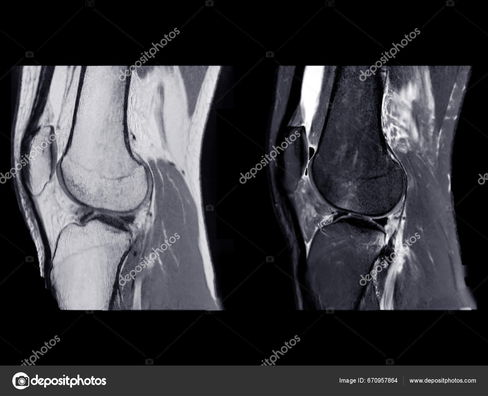T2 Mri Of The Knee
