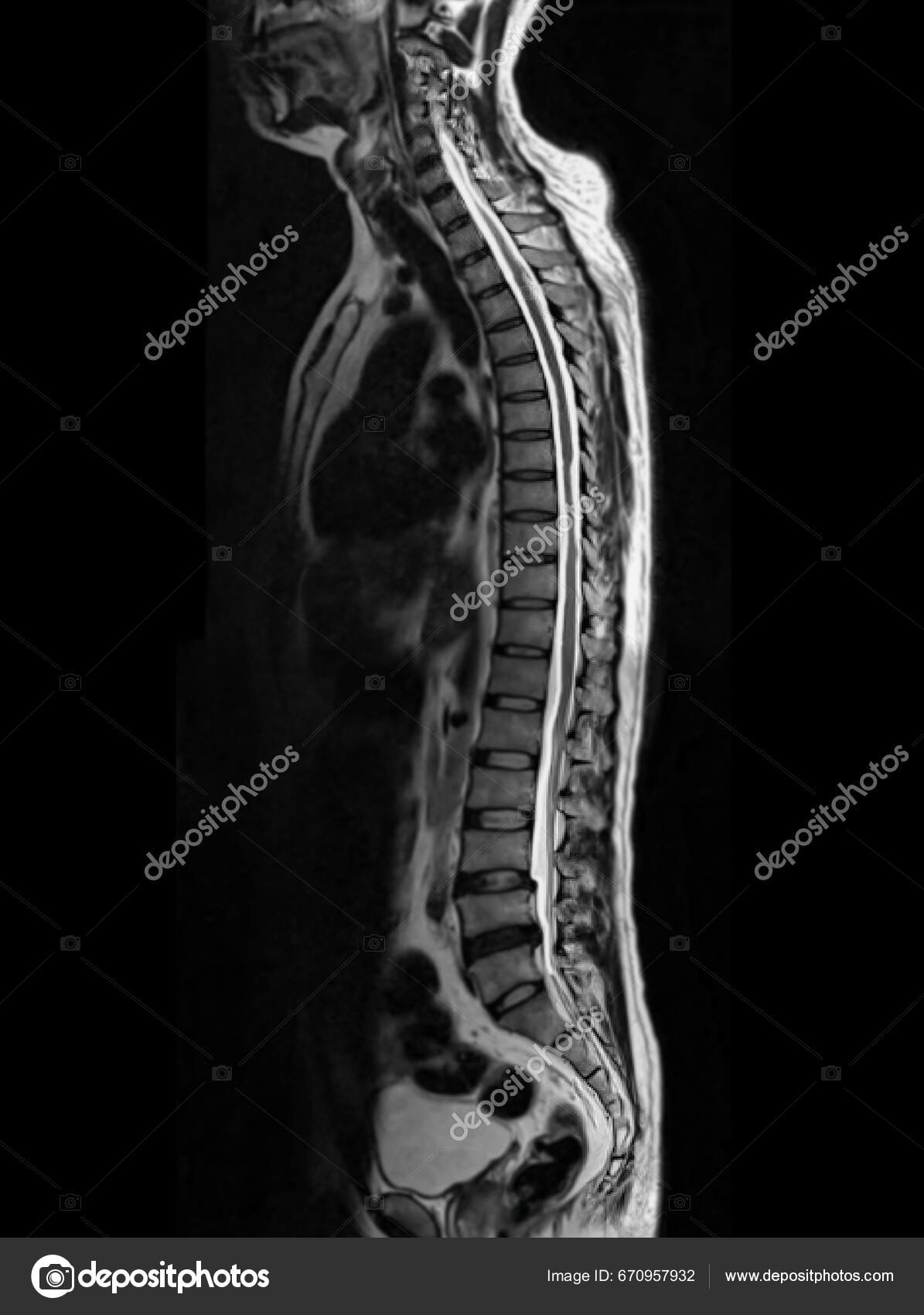 Resonancia Magnética Columna Vertebral Completa Plano Sagital T2W Para ...