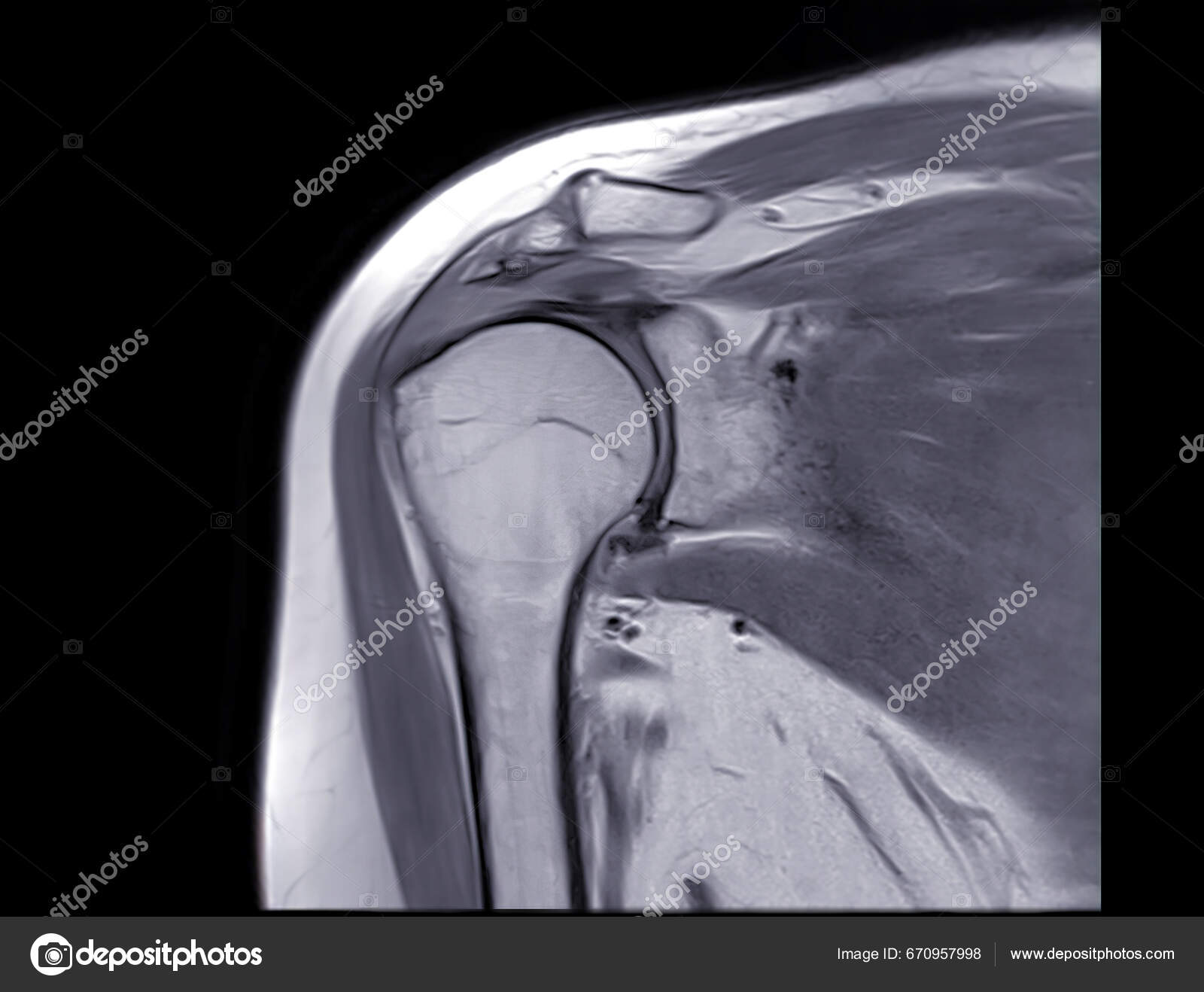Shoulder Joint Anatomy Mri