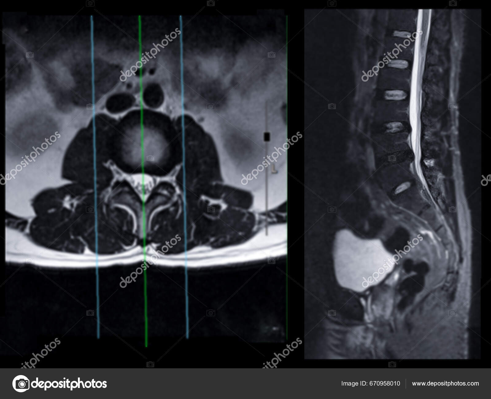 Lumbar Spine Mri Axial