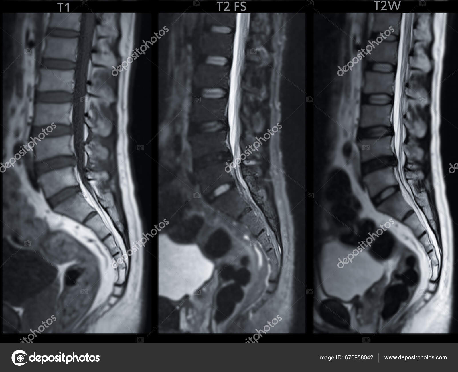 Hernie Discale Irm | ppgbbe.intranet.biologia.ufrj.br