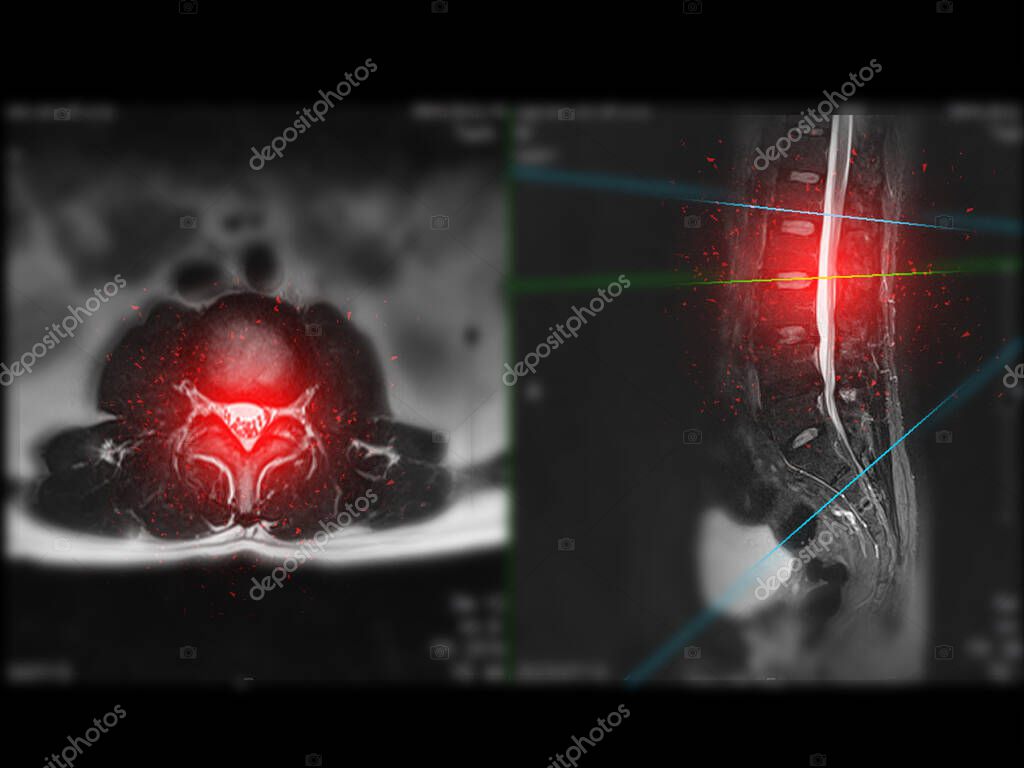 Resonancia magnética L-S columna vertebral o columna lumbar Vista axial ...