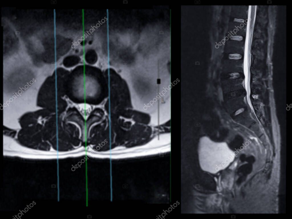 Resonancia magnética L-S columna vertebral o columna lumbar Vista axial ...
