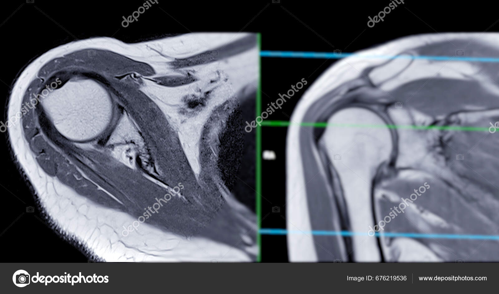 Magnetic Resonance Imaging Mri Shoulder Joint Diagnostic Shoulder Pain ...