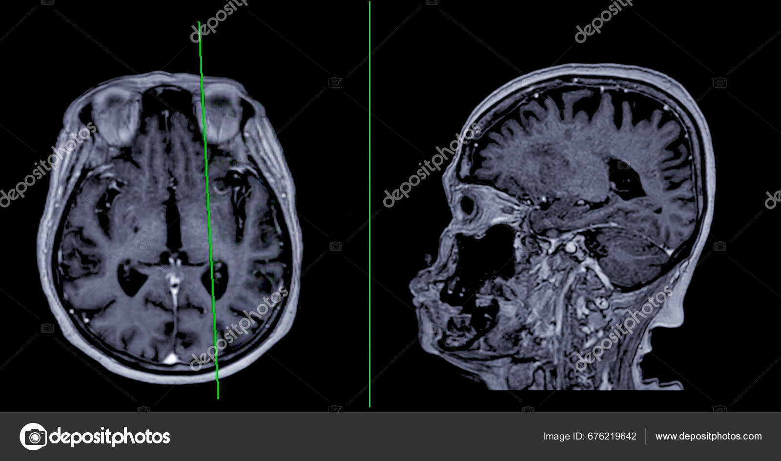Mrt Gehirn Scan Axiale Und Sagittale Ansicht Mit Referenzlinie Zur ...