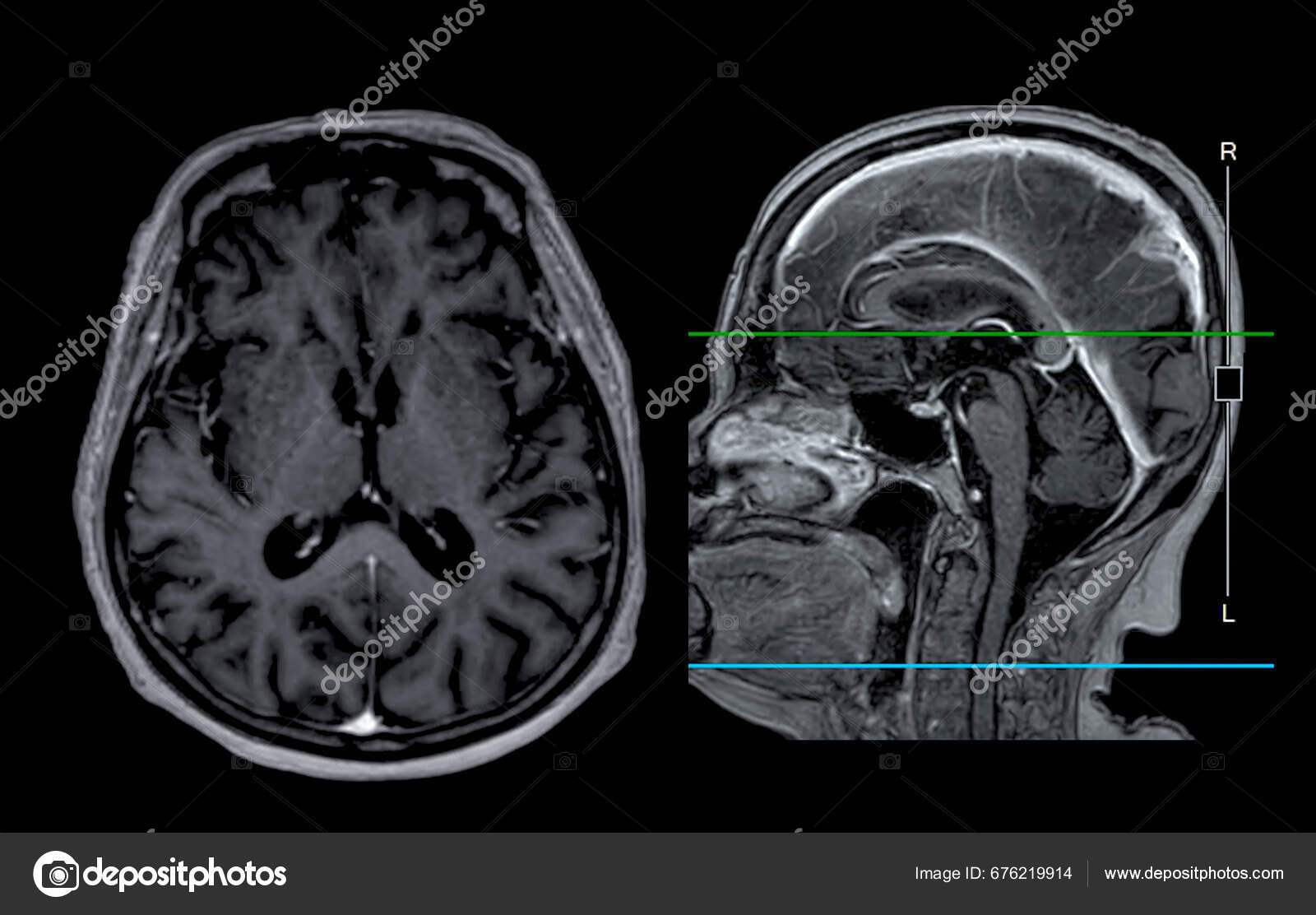 Mri Scan Otak Pemantauan Sumbu Dan Sagital Dengan Garis Referensi ...