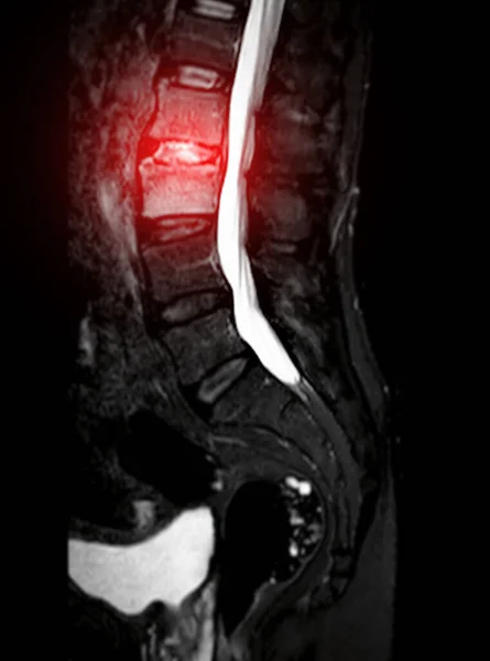 Mri Tulang Belakang Atau Lumbar Tampilan Sagittal Untuk Diagnosis ...
