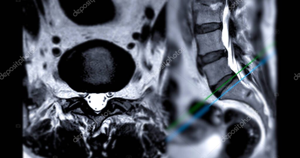 RM L-S columna vertebral o columna lumbar Técnica axial y sagital T2 ...