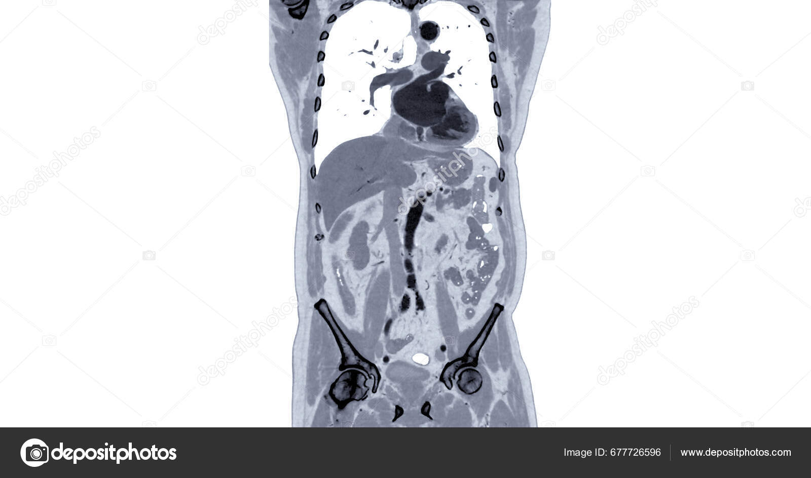 Tomografía Computarizada Tórax Abdomen Con Contraste Inyectable Vista ...