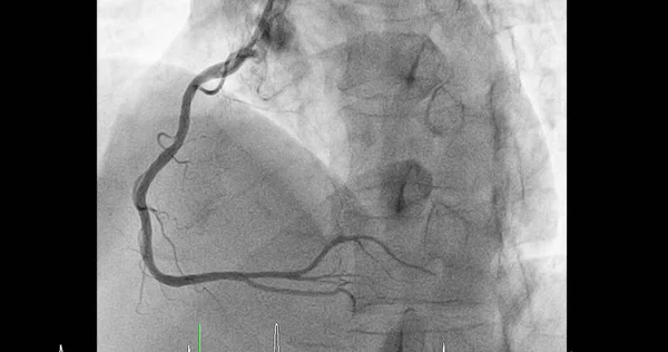 Cardiac Catheterization Left Anterior Descending Artery Lad Can Help ...