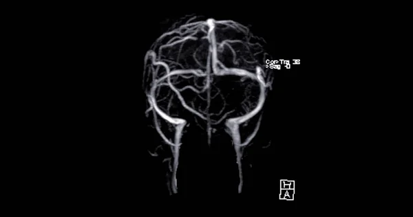 Mrv Brain Magnetic Resonance Venography Brain Diagnosis Abnormalities ...