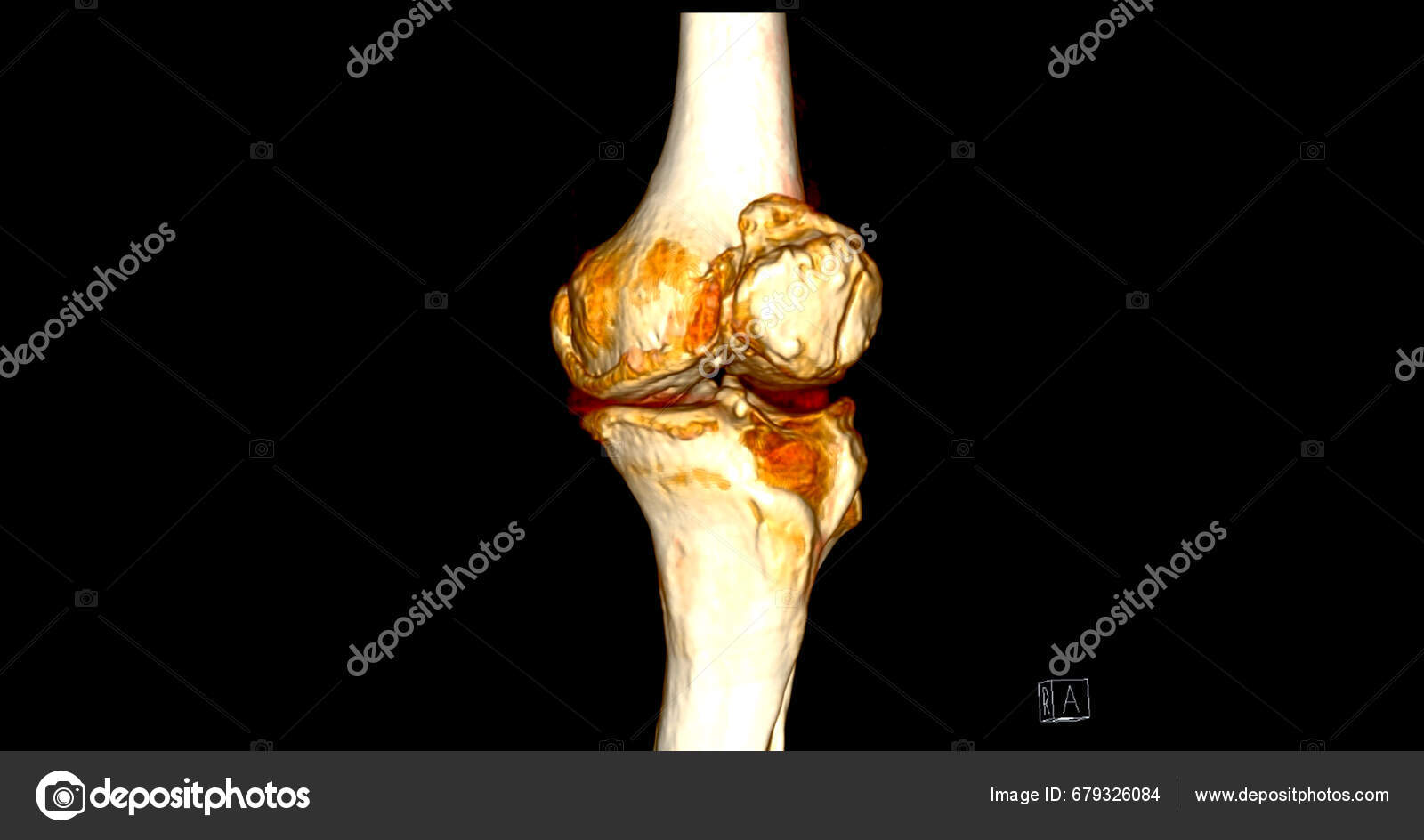 Tomografía Computarizada Articulación Rodilla Que Muestra Fractura ...