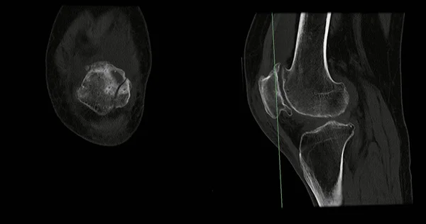 Scan Knee Joint Sagittal Coronal Case Fracture Patella Bone — Stock ...