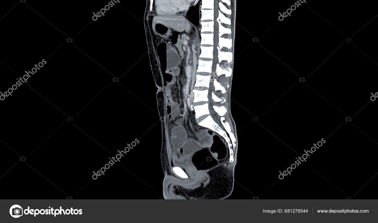 Chest Abdomen Injection Contrast Media Coronal View Diagnosis Chest ...