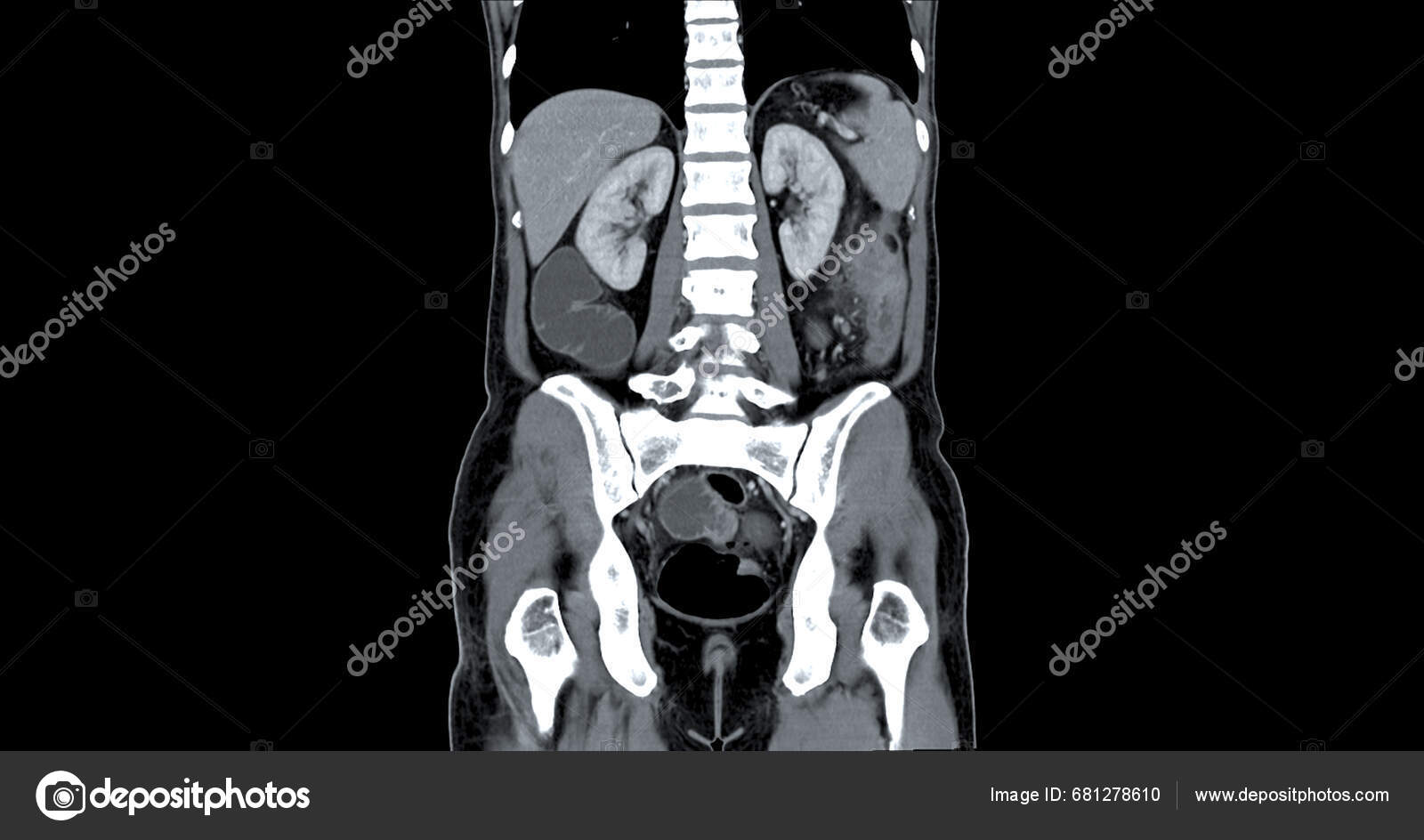 Chest Abdomen Injection Contrast Media Coronal View Diagnosis Chest ...