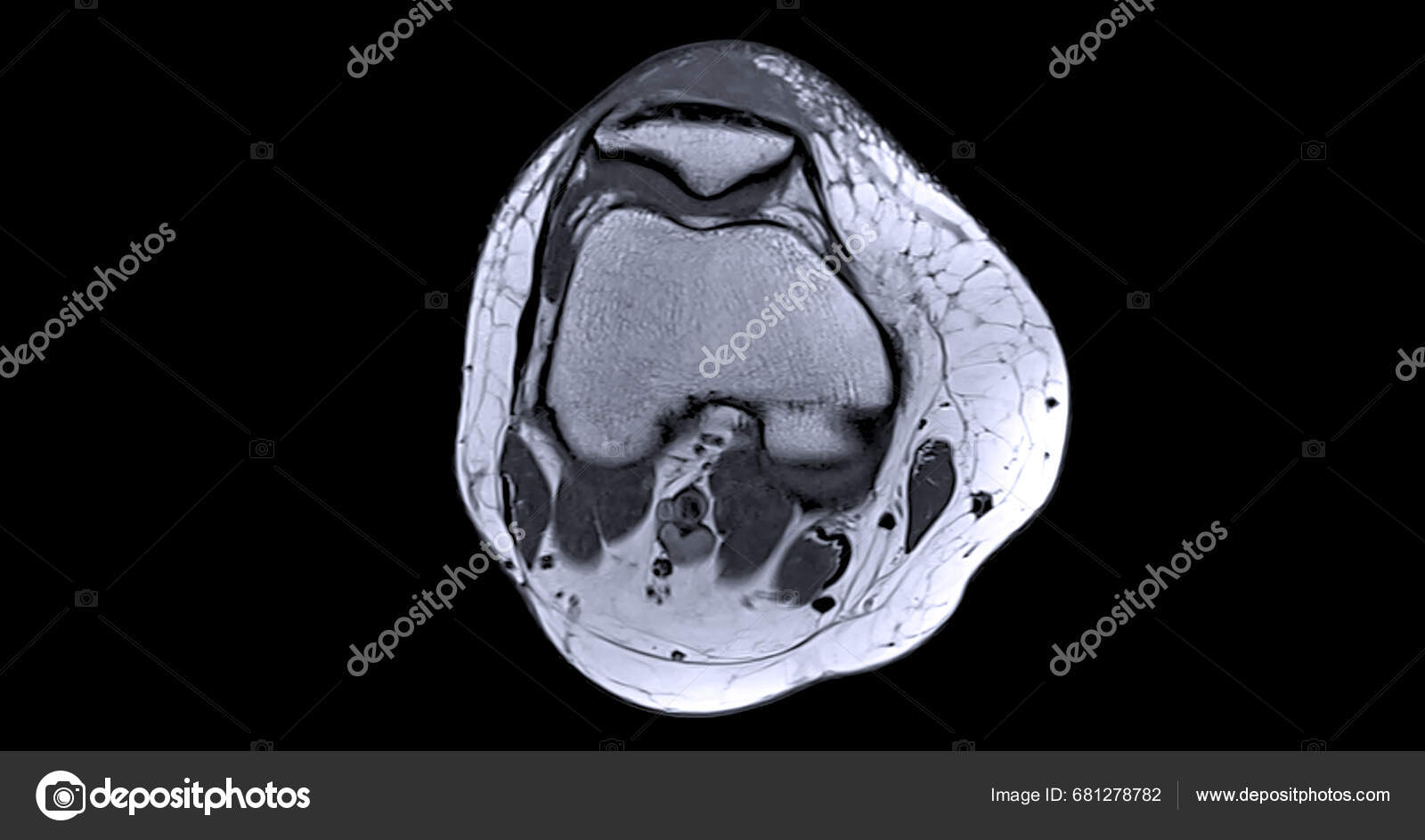 Pencitraan Resonansi Magnetik Atau Mri Sendi Lutut Untuk Mendeteksi Air ...