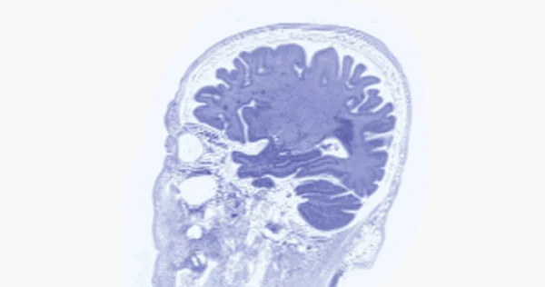 Candidiasis images libres de droit, photos de Candidiasis | Depositphotos